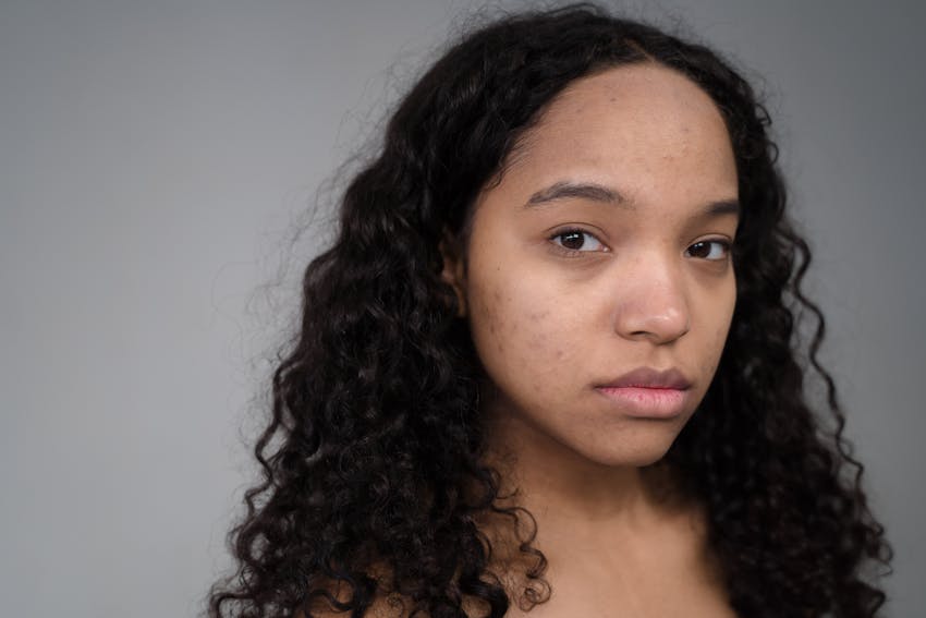 How to Use a Warm Compress to Gently Get Rid of a Pimple 😊 - Acne Curing